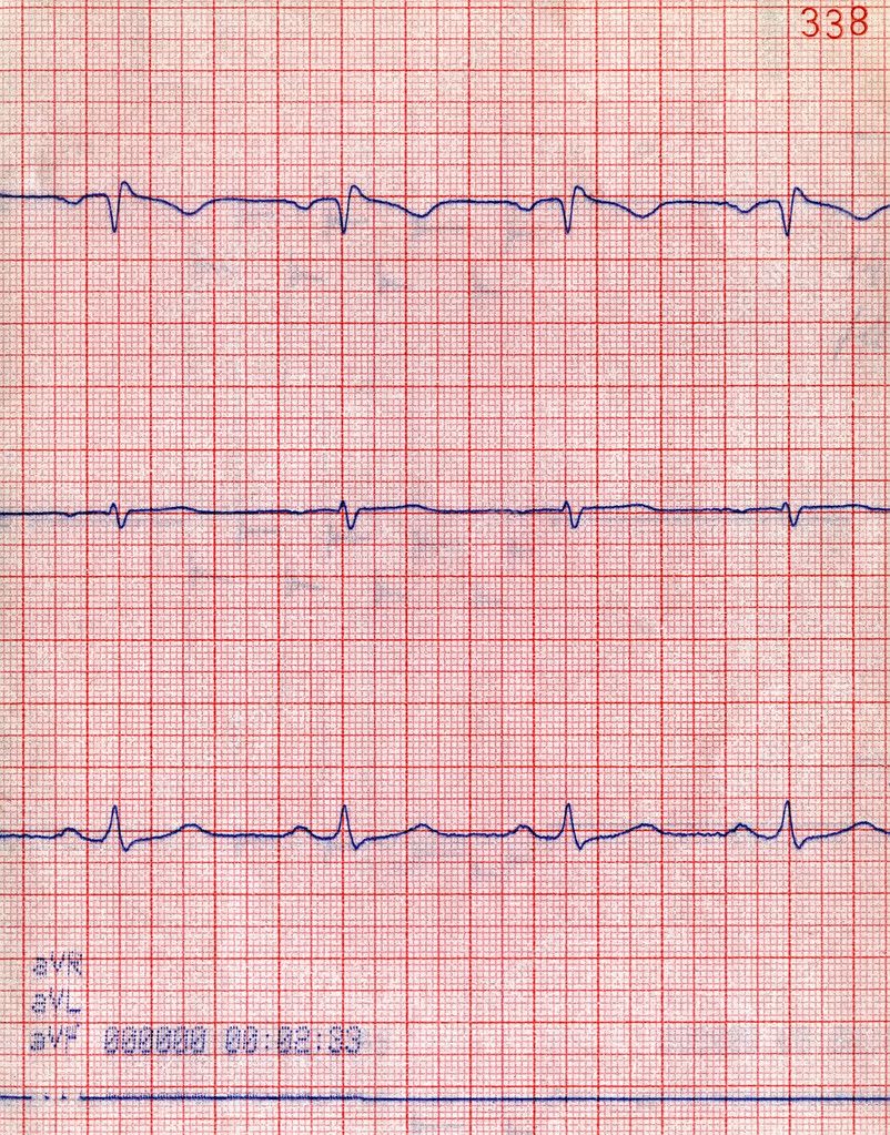 Diagrama de latidos cardíacos macro cardio, concepto de estrés del ...