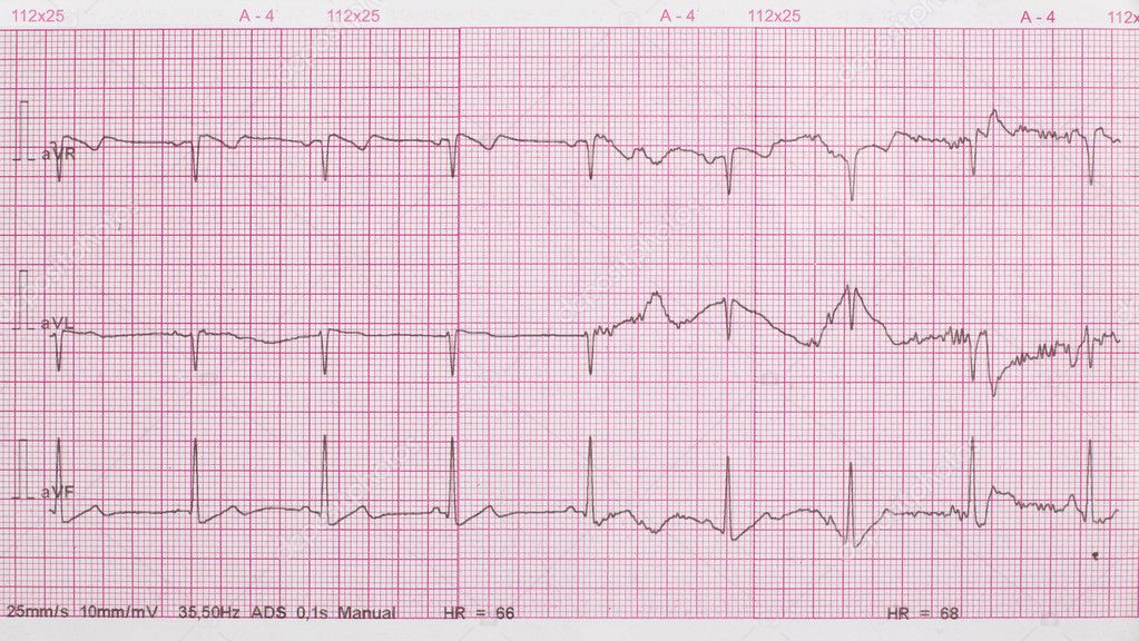 ECG print — Stock Photo © wacpan #2875484