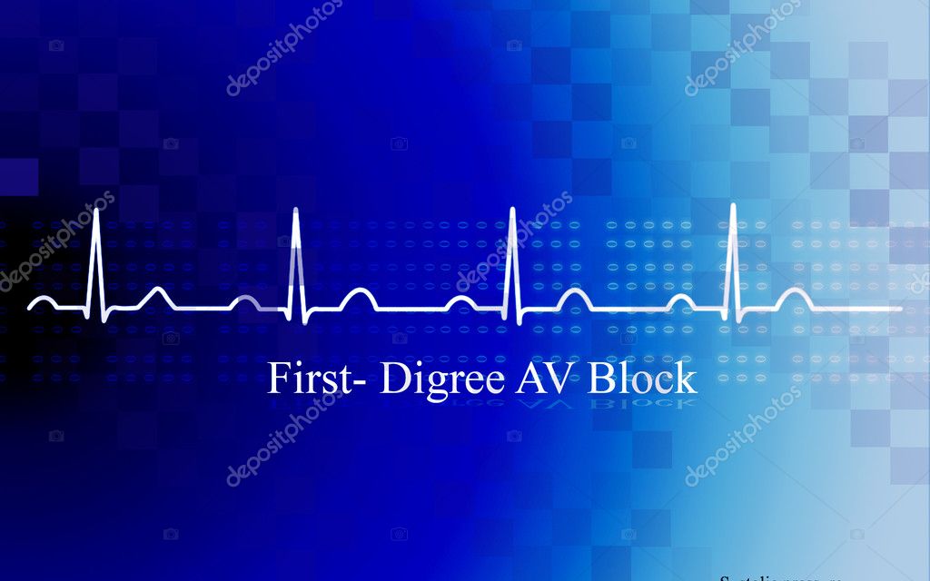 First degree AV block in coronary diseas — Stock Photo © jscreationzs ...