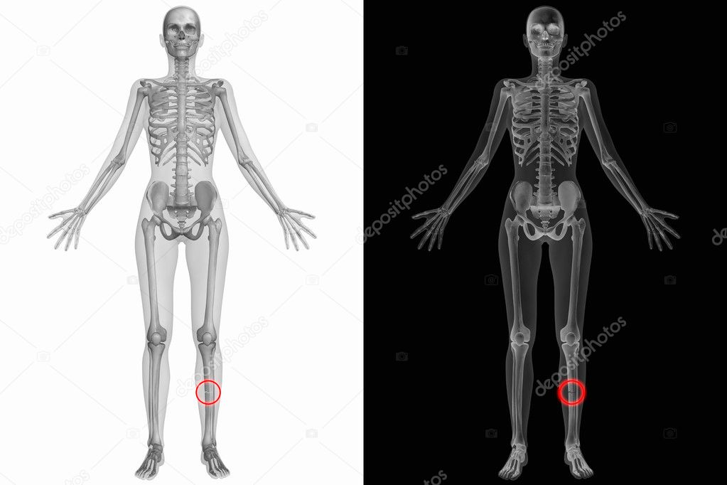Human Anatomy with broken bone Stock Photo by ©Digitalstudio 3100457